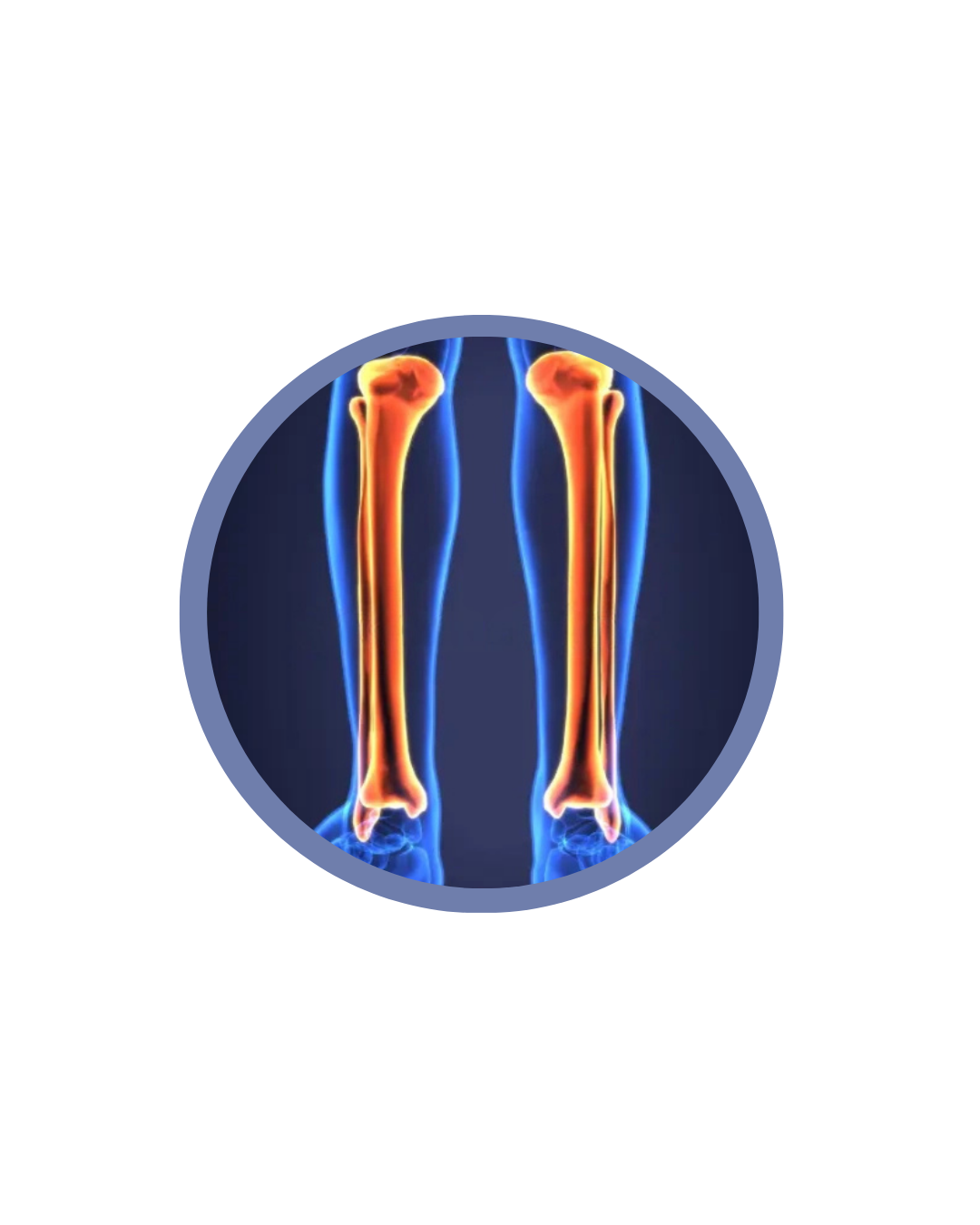 Tibia Locking - Mechfix Implants